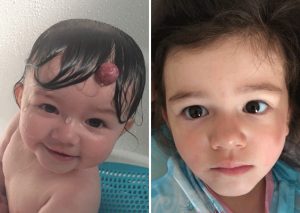 Osler-Weber-Rendu Syndrome Symptoms and Treatment | New York, NY