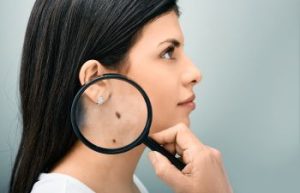 Suddenly Appearing Moles ( Nevi) Evaluation and Treatment | New York, NY