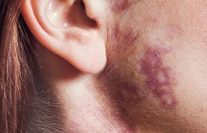 Port Wine Stain Birthmark or a Bruise? Understanding the Differences ...